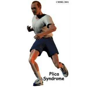 Plica Syndrome - Paul Kiritsis, MD - Richmond, VA Premier Orthopedic ...
