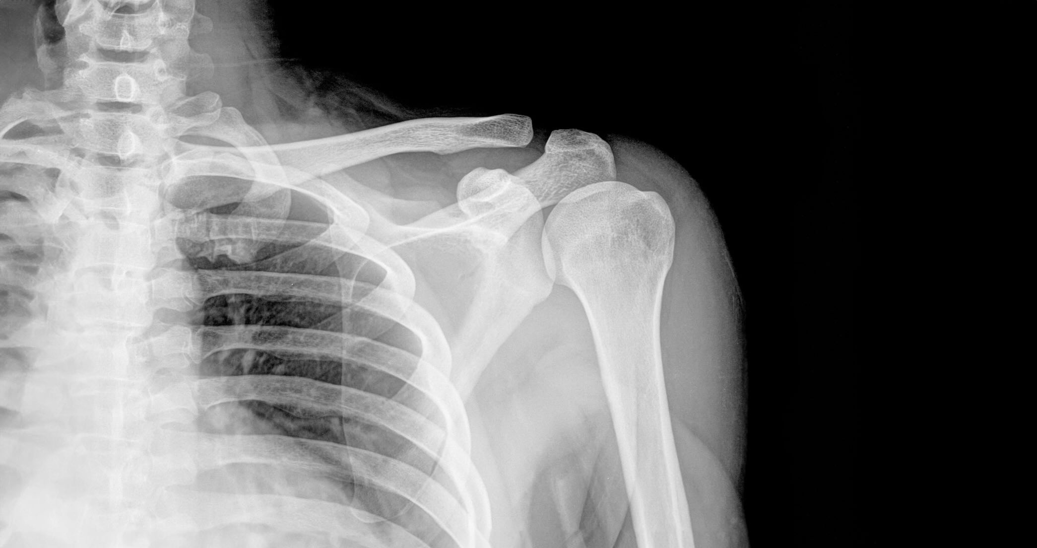 Precision Shoulder Image Case Library - Paul Kiritsis, MD - Richmond ...