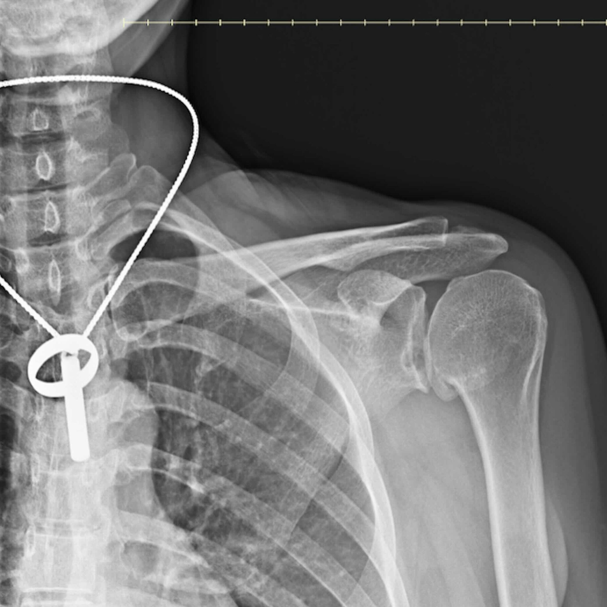 Precision Shoulder Replacement Richmond, VA | Dr. Paul Kiritsis