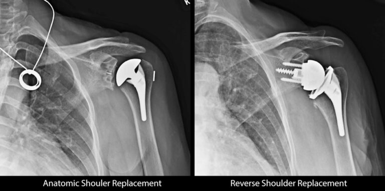 What Is the Success Rate of Shoulder Replacement Surgery? - Paul ...