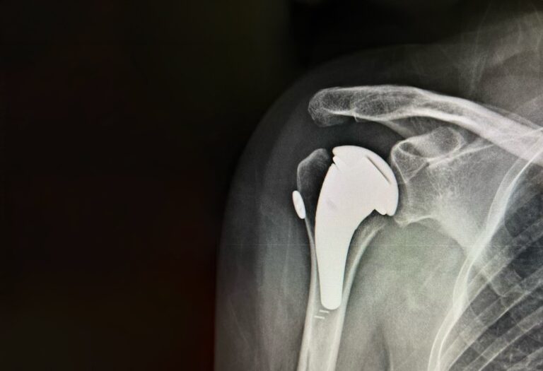 Anatomic Total Shoulder Replacement in Richmond, VA | Paul Kiritsis, MD