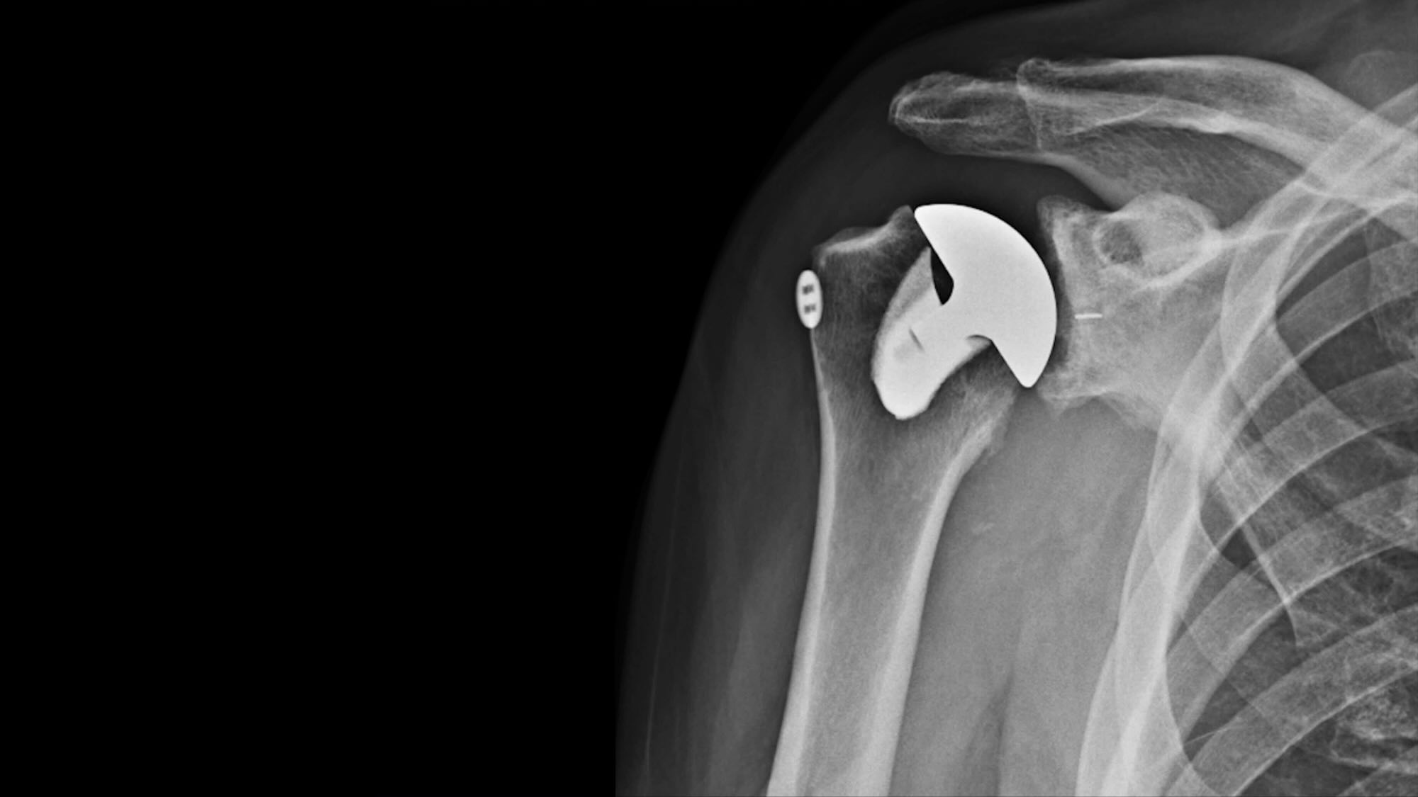 Precision Shoulder Candidate - Paul Kiritsis, MD - Richmond, VA Premier ...