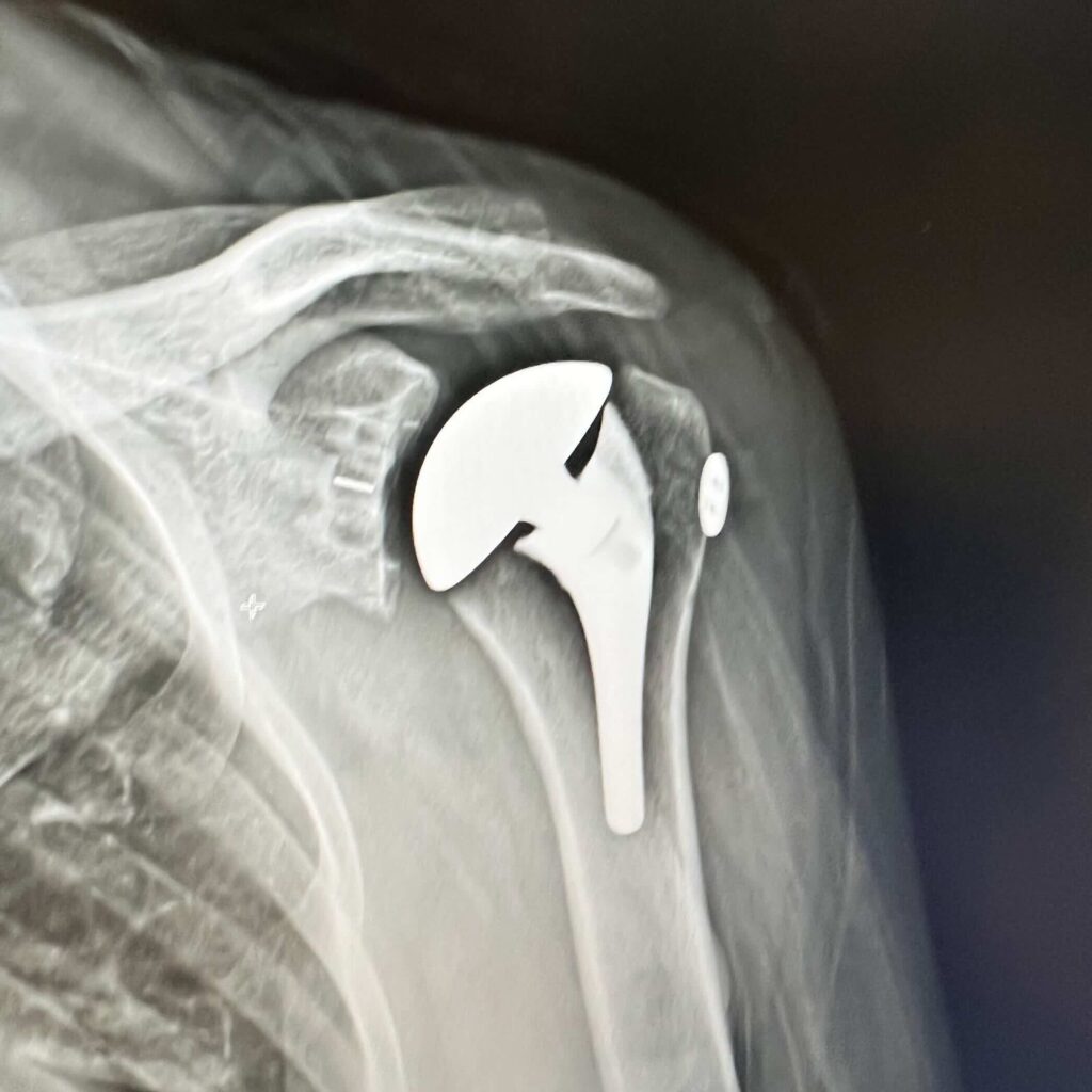 Precision Shoulder Image Case Library - Paul Kiritsis, MD - Richmond ...