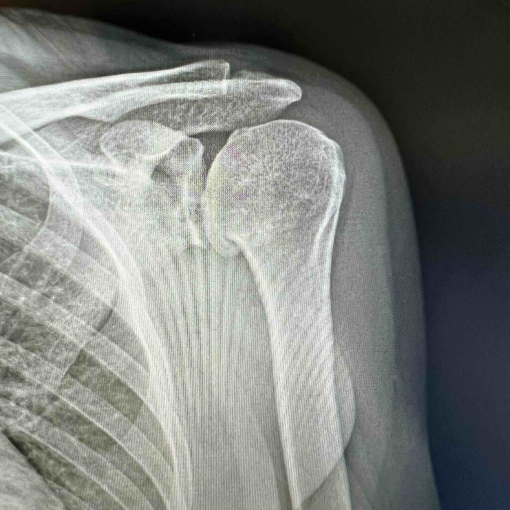 Precision Shoulder Image Case Library - Paul Kiritsis, MD - Richmond ...