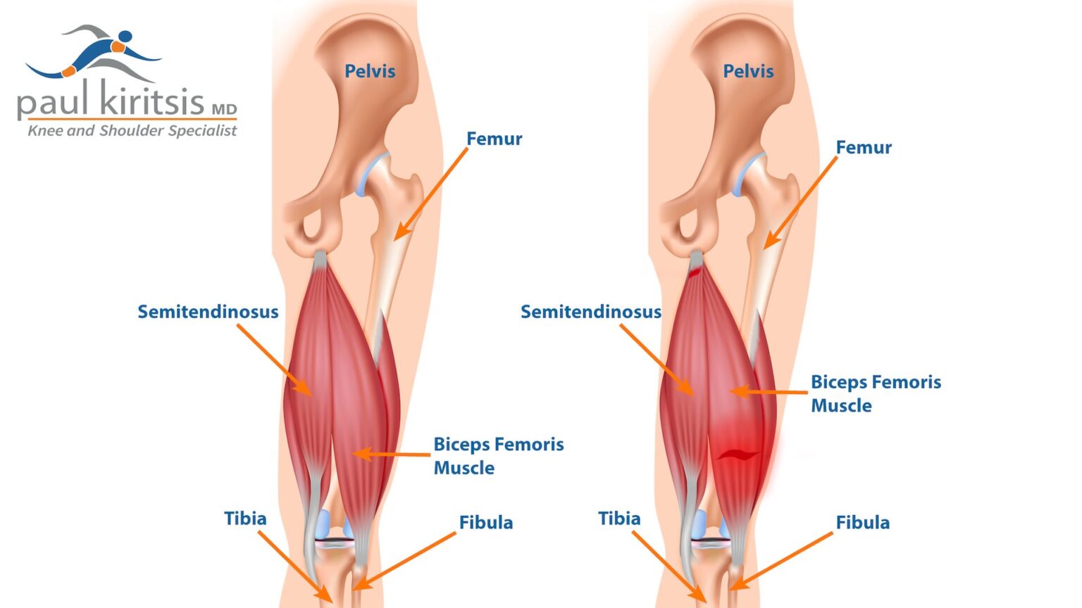 Can A Hamstring Injury Cause Knee Pain? - Paul Kiritsis, MD - Richmond, VA Premier Orthopedic ...